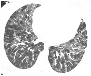 Reticular Opacities | Radiology Key