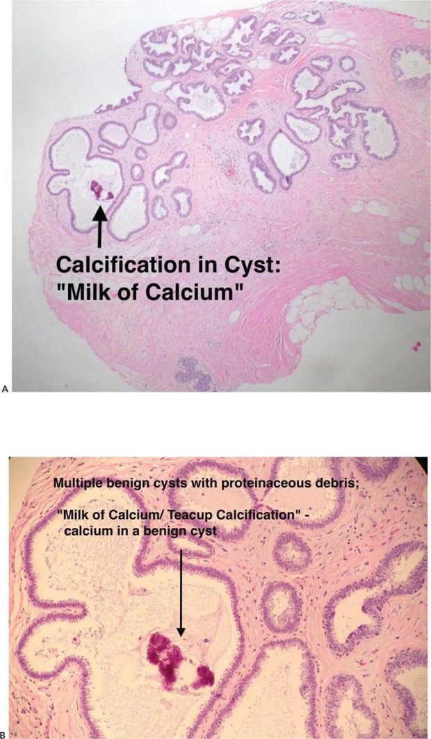 C: Microlobulated | Radiology Key
