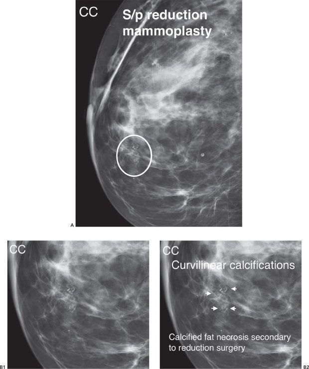 B: Milk Of Calcium (Teacup) | Radiology Key