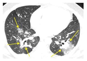 Reticular Opacities | Radiology Key