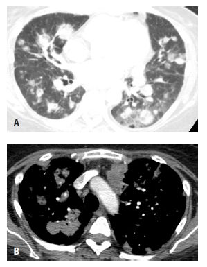 Reticular Opacities | Radiology Key