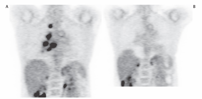 Therapy Response | Radiology Key