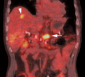 Pancreatic Cancer | Radiology Key