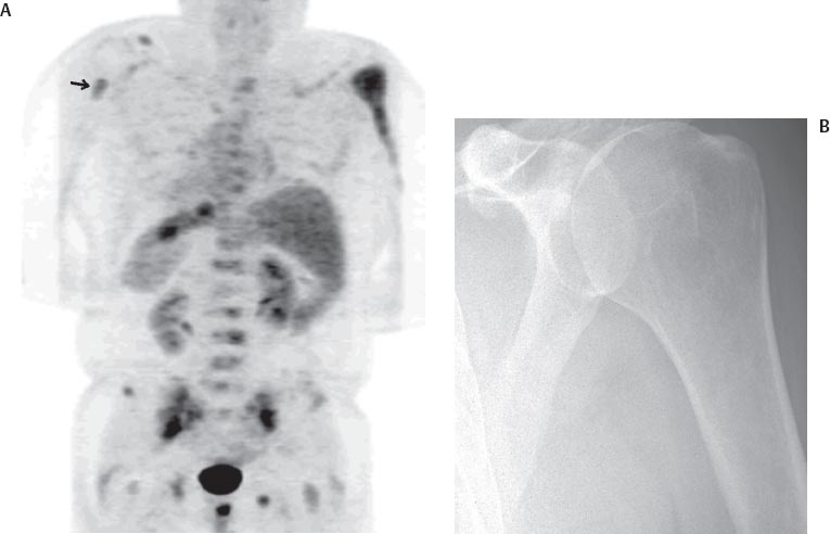 Musculoskeletal Tumors | Radiology Key