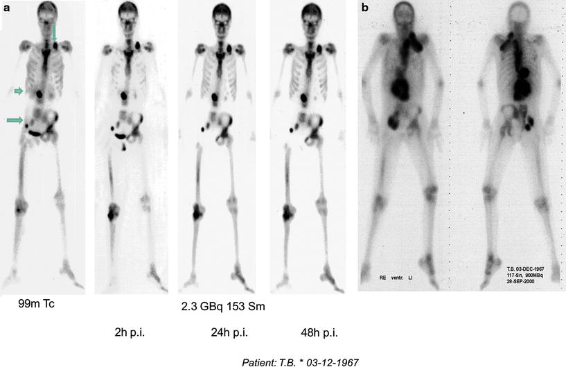 Bisphosphonates for Bone Pain Palliation | Radiology Key