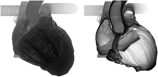 a Patient-Specific Model Heart from CT Data | Radiology Key