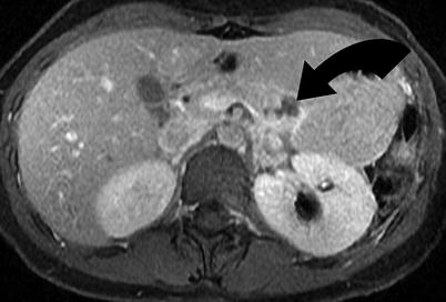 Imaging of Acute Pancreas | Radiology Key