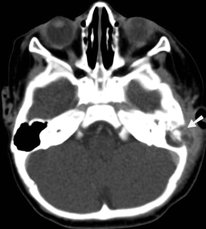 Imaging of Neck Emergencies | Radiology Key