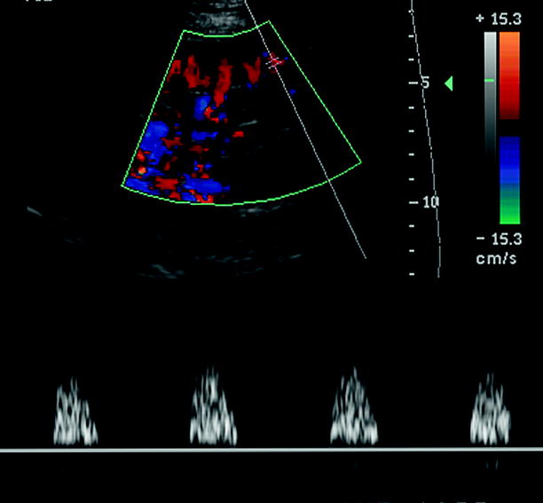 Imaging of Genitourinary Emergencies | Radiology Key