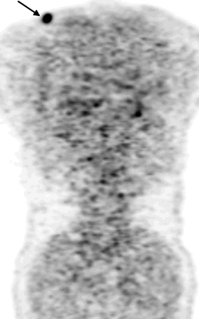 Skin Melanoma | Radiology Key