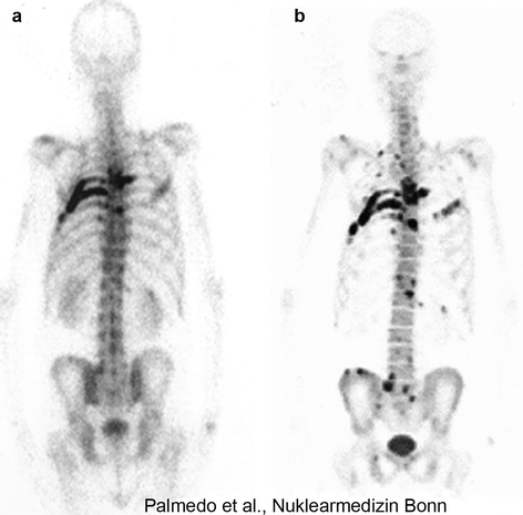 Musculoskeletal Tumors | Radiology Key