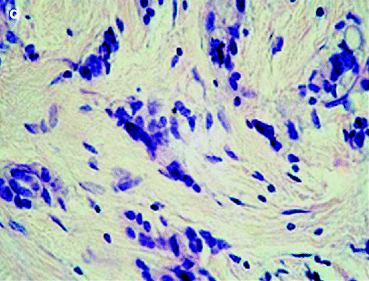 Breast Cancer | Radiology Key