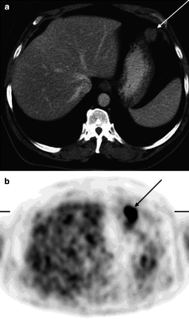 Stomach Cancer | Radiology Key