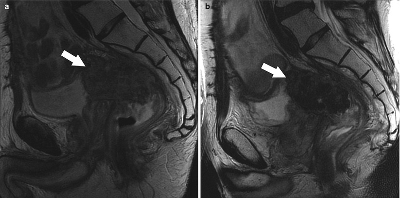 MRI for Perianal Fistula | Radiology Key