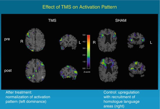 PET Reveals Pathophysiology in Ischemic Stroke | Radiology Key