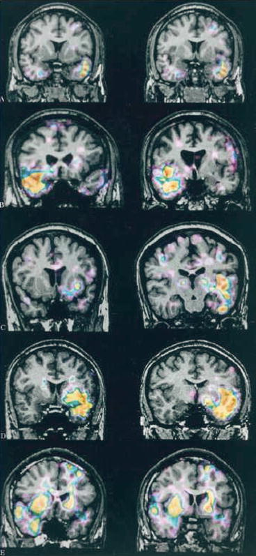 SISCOM (Subtraction Ictal SPECT Coregistered to MRI) | Radiology Key