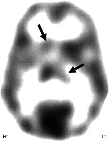 Radionuclide Imaging Studies in Pediatric Neurology | Radiology Key