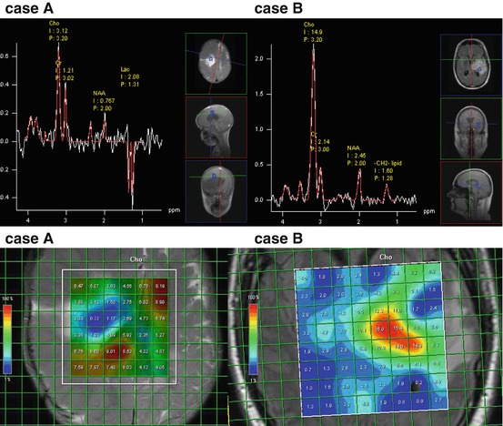 Molecular Imaging Using Magnetic Resonance Spectroscopy in Neurology ...