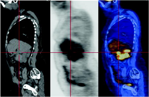 Recurrent Gallbladder Carcinoma | Radiology Key