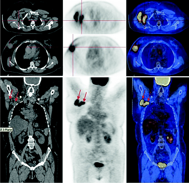 Staging of Breast Cancer with Axillary Lymphadenopathy | Radiology Key