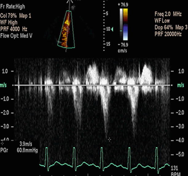 Hypertrophic Cardiomyopathy and Mitral Valve Disease | Radiology Key
