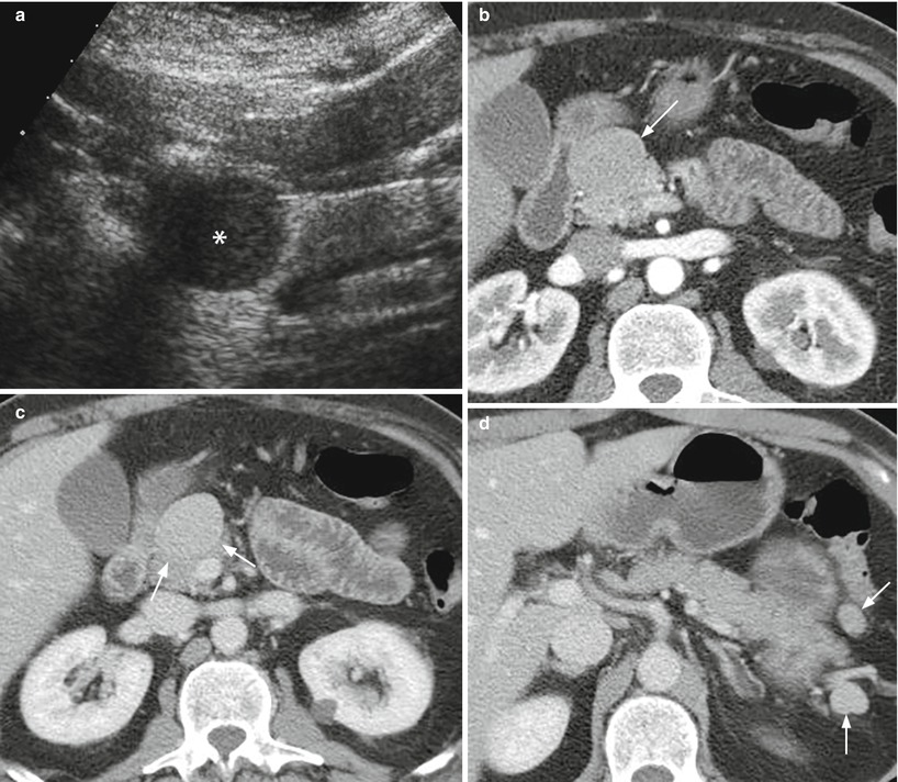 Neoplasms | Radiology Key