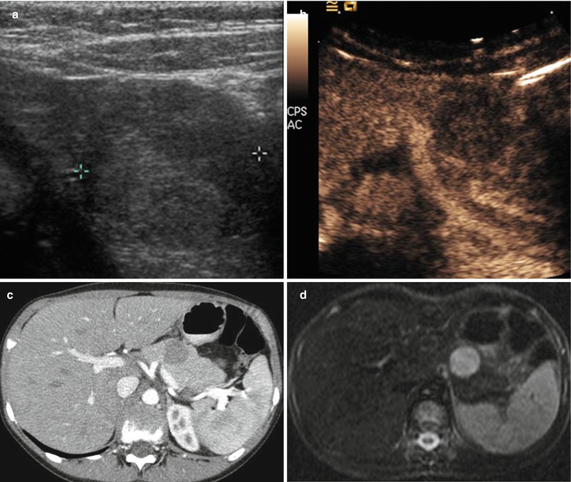 Pseudopapillary Neoplasms | Radiology Key
