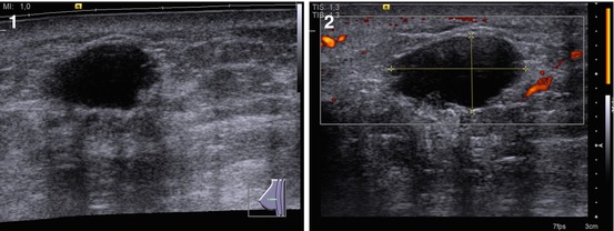 Differential Diagnosis of Male Breast Cancer | Radiology Key