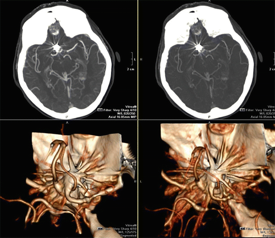 Dual Energy-Spectral CT in Neurovascular Imaging | Radiology Key