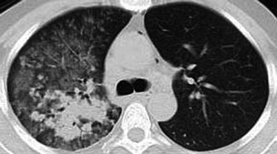 Pulmonary Tuberculosis | Radiology Key
