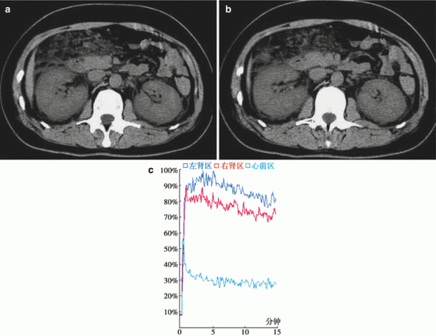 Diphtheria | Radiology Key