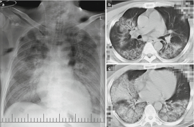 Neonatal Tetanus | Radiology Key