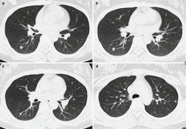 Psittacosis | Radiology Key