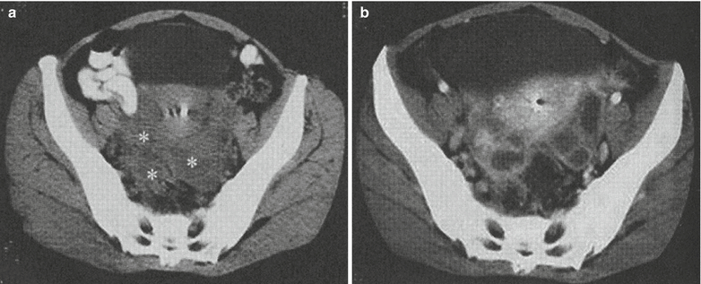 Gonorrhea | Radiology Key