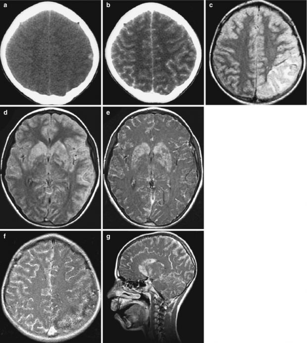 Diphtheria | Radiology Key