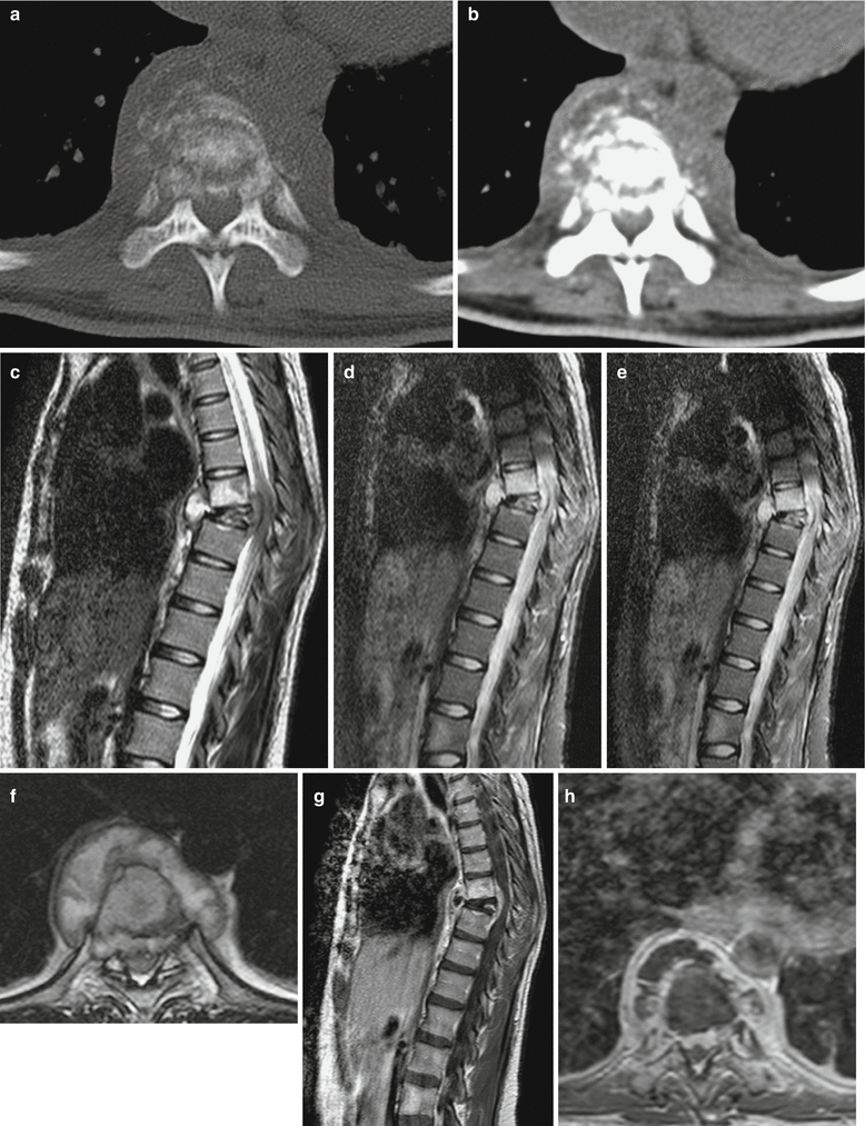 Pulmonary Tuberculosis | Radiology Key