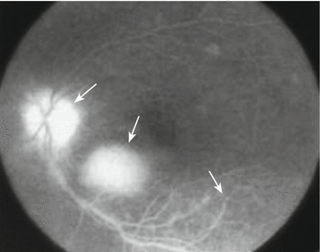 Syphilis | Radiology Key