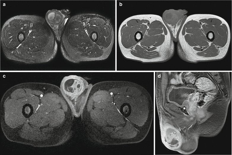 Brucellosis | Radiology Key