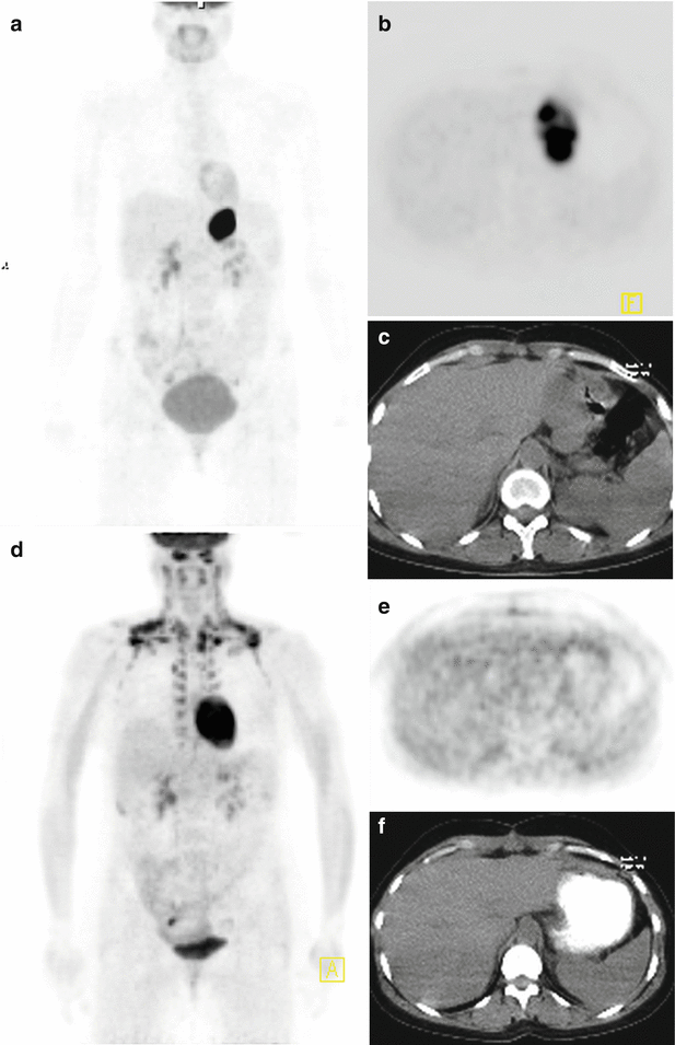 Gastrointestinal Stromal Tumors | Radiology Key