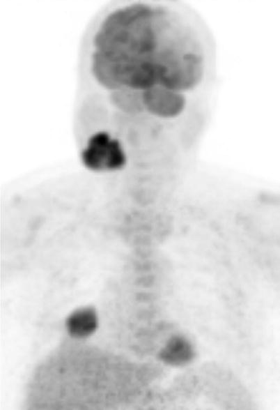 Head and Neck Cancer | Radiology Key