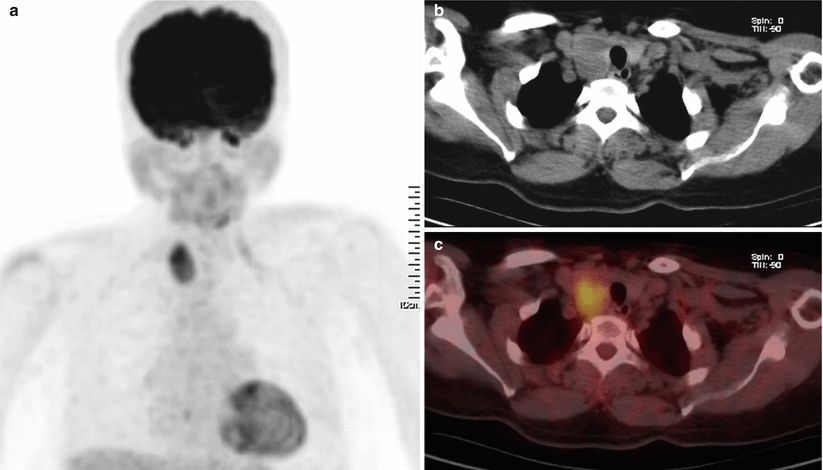 Thyroid Cancer | Radiology Key