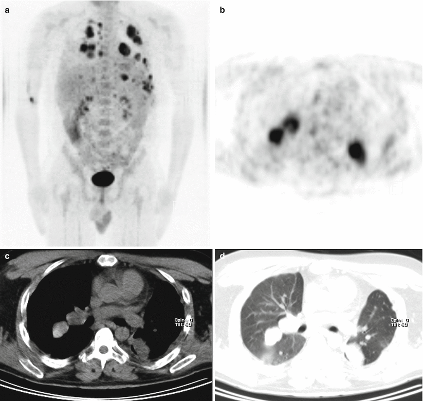 Lung Cancer | Radiology Key