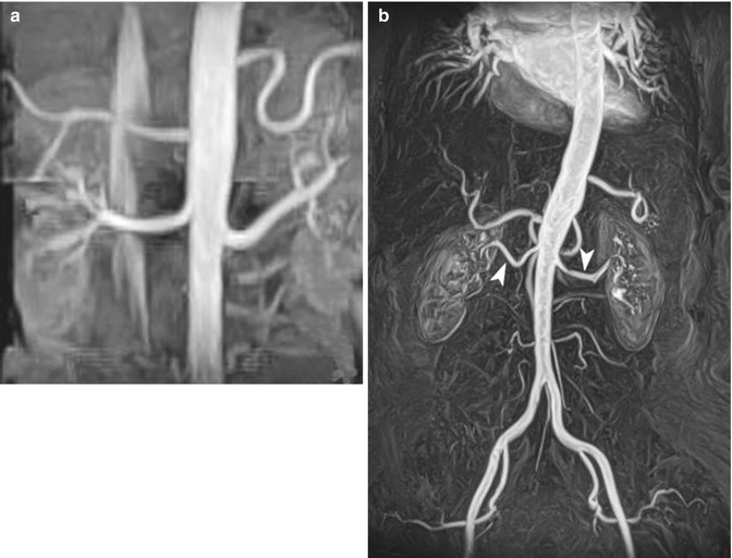 Abdominal Cavity, Peritoneum and Retroperitoneum | Radiology Key