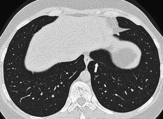 Thorax | Radiology Key