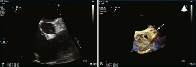 Evaluation of the Aortic Valve | Radiology Key