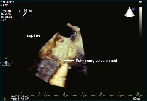 Pulmonary Valve in Health and Disease | Radiology Key