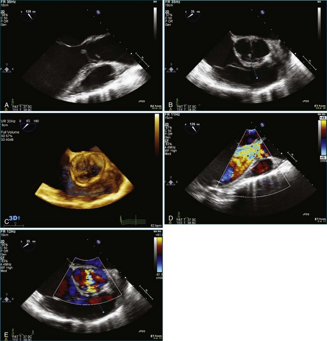 Evaluation of Intracardiac Masses | Radiology Key