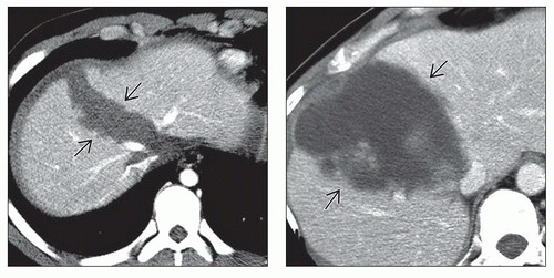 Biloma | Radiology Key