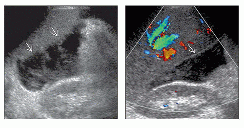 Biloma | Radiology Key