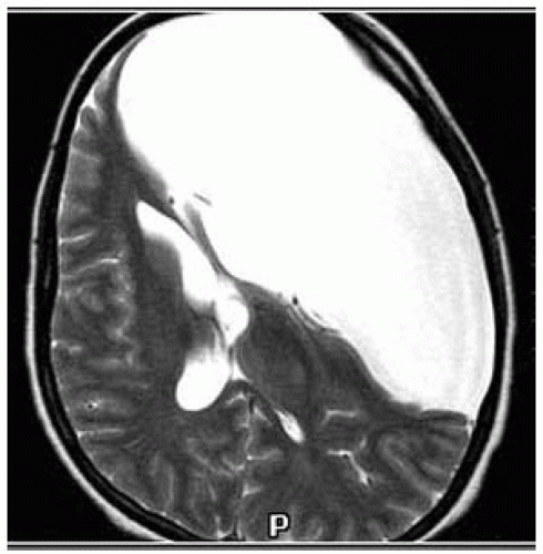 Extra-Axial Masses | Radiology Key